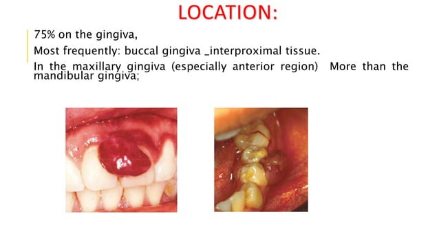 Pyogenic Granuloma | PPT