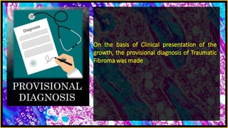 Pyogenic granuloma | PPTX