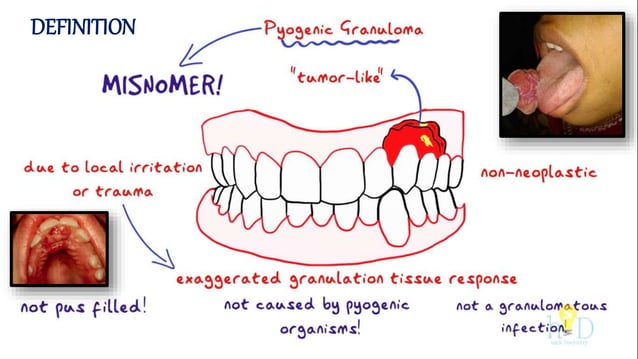 Pyogenic granuloma | PPTX | Dental Health | Diseases and Conditions