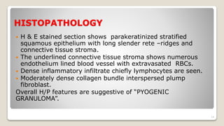 Pyogenic granuloma a case presentation | PPTX