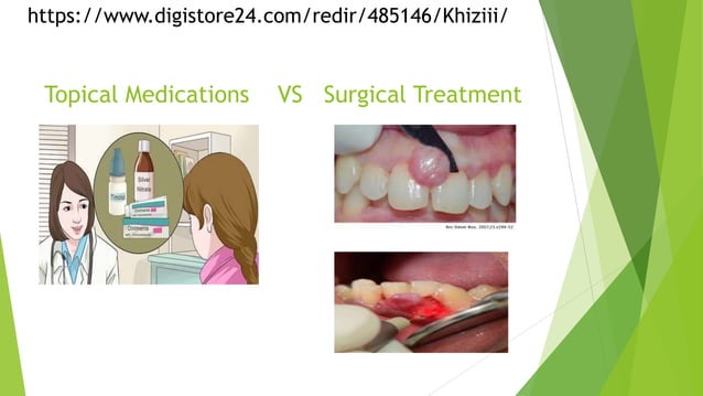 Pyogenic granuloma Presentation | PPTX | Dental Health | Diseases and ...