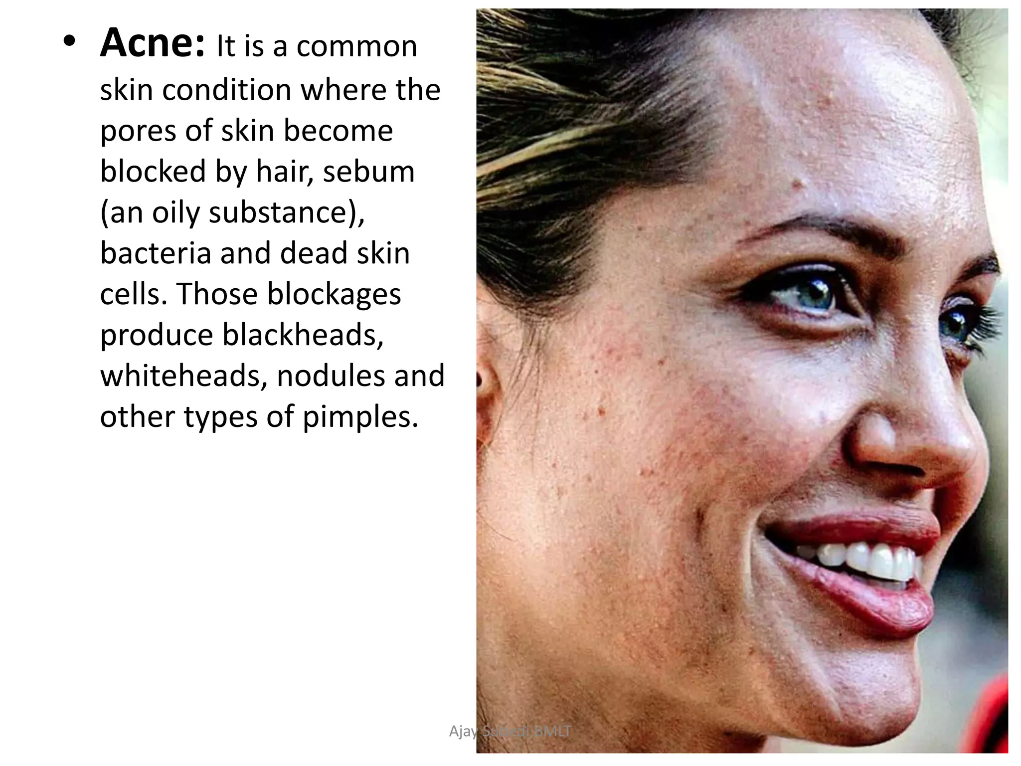 pyogenic infection.pptx