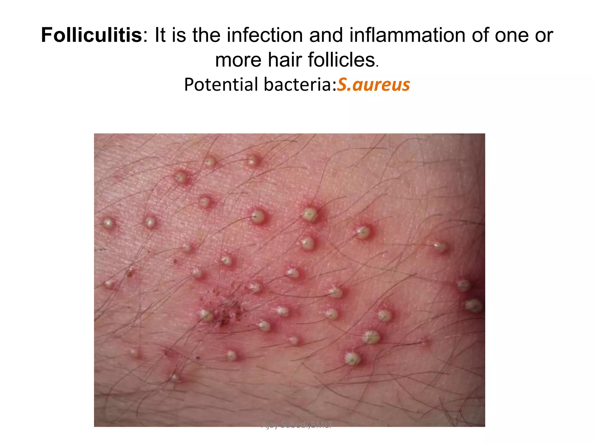 pyogenic infection.pptx