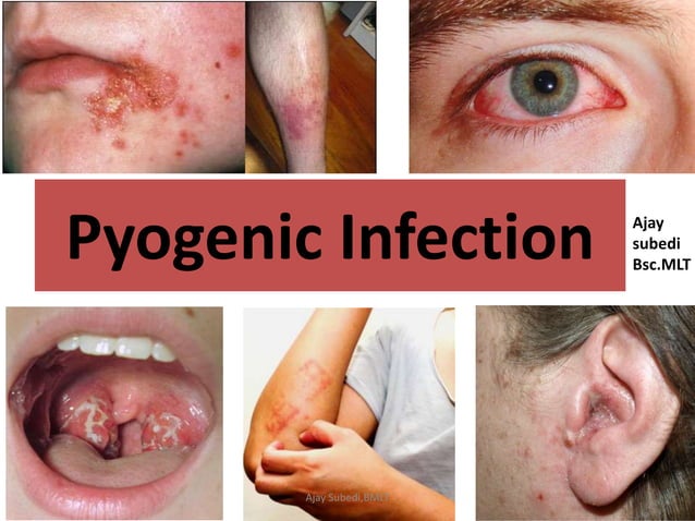 pyogenic infection.pptx | Skin and Dermatology | Diseases and Conditions