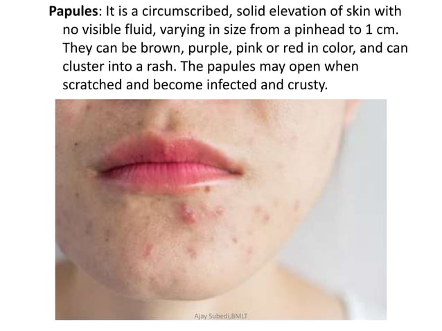 pyogenic infection.pptx | Skin and Dermatology | Diseases and Conditions