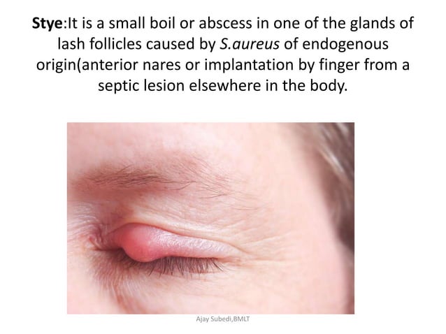 pyogenic infection.pptx | Skin and Dermatology | Diseases and Conditions