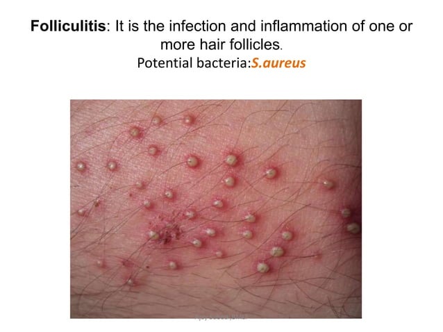 pyogenic infection.pptx | Skin and Dermatology | Diseases and Conditions