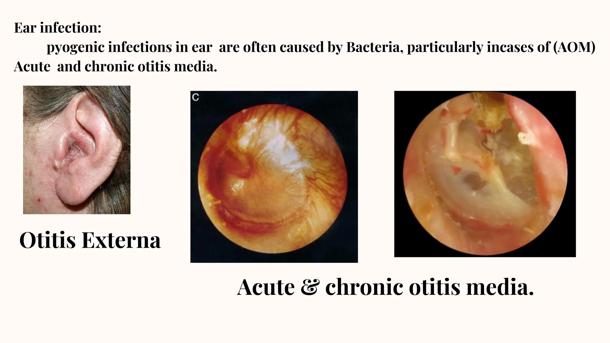 Pyogenic infection by Tharanisha.M _20240425_072415_0000.pdf