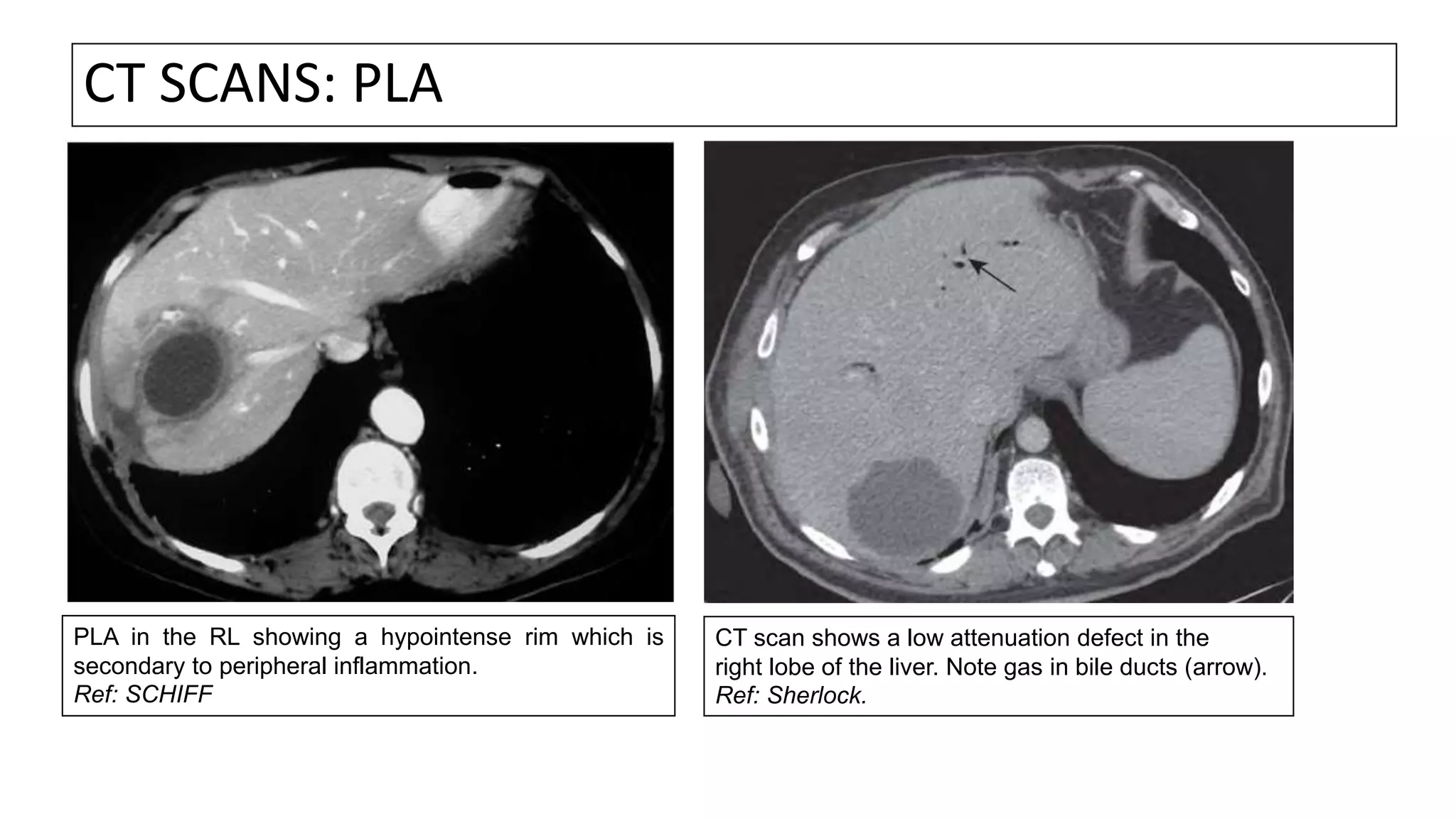 Pyogenic liver abscess | PPTX