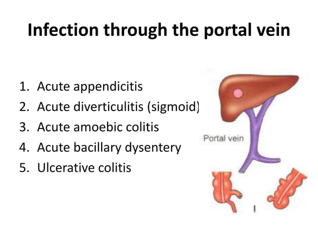 PYOGENIC LIVER ABSCESS.pptx | Medical Health