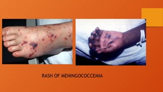 PYOGENIC MENINGITIS- CLINICAL FEATURES AND MANAGEMENT | PPTX