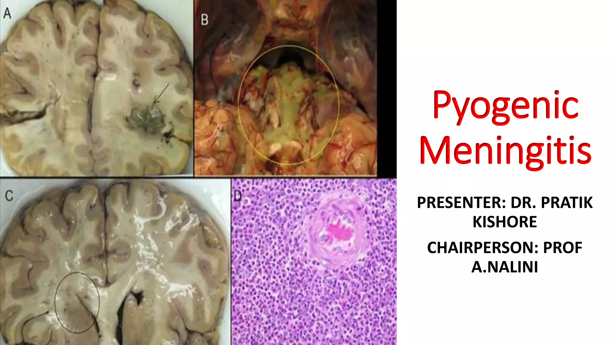 Pyogenic meningitis (nimhans) | PPT