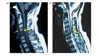 Pyogenic spine infections | PDF
