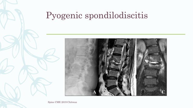 Pyogenic spondylitis cme chitwan 2019 | PPTX | Bone and Joint ...