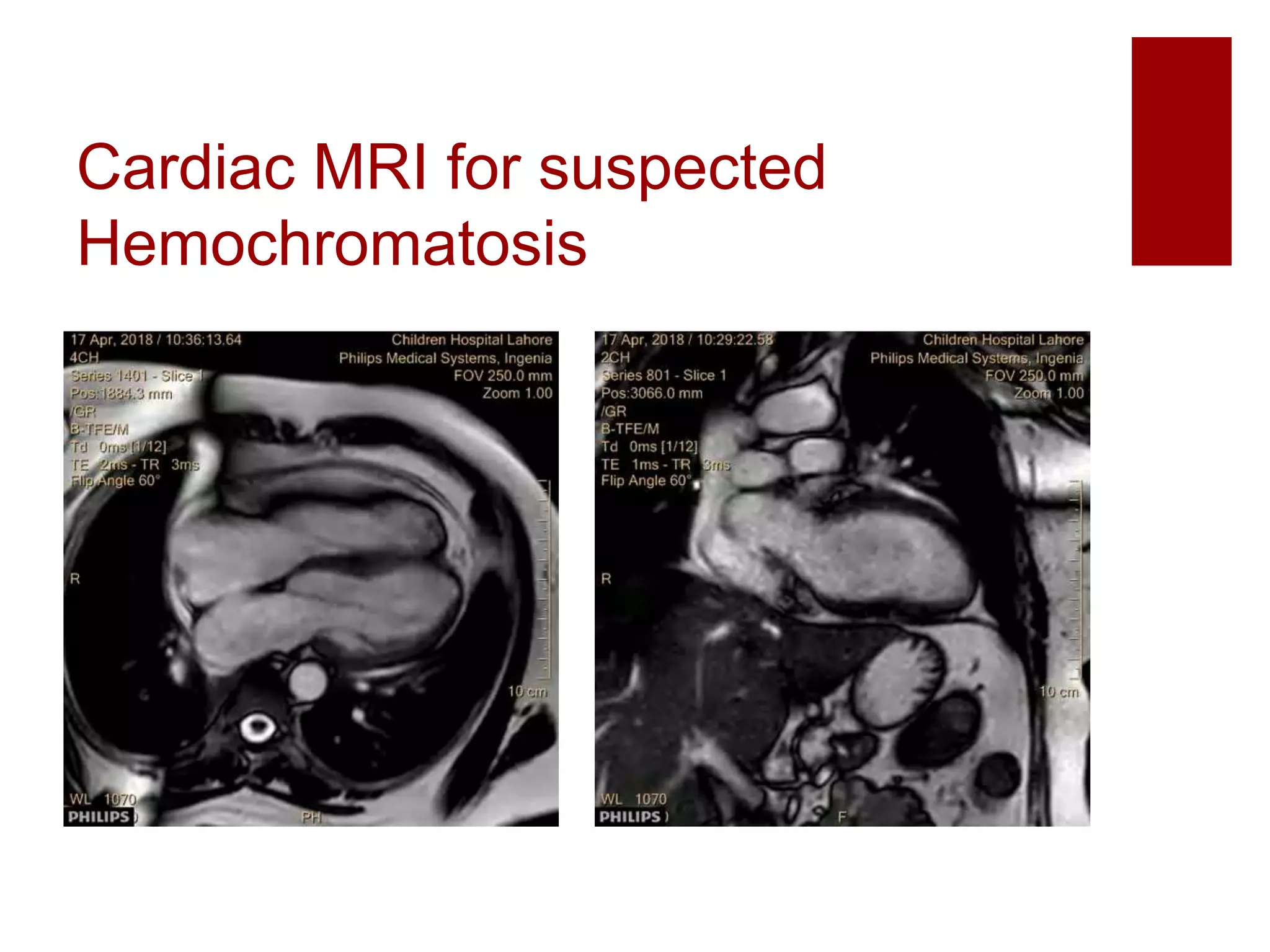 Diagnosis of Cardiac Amyloidosis with PYP Imaging | PPTX