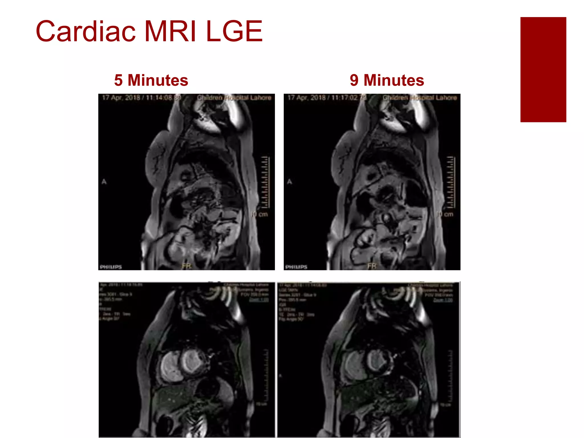 Diagnosis of Cardiac Amyloidosis with PYP Imaging | PPTX