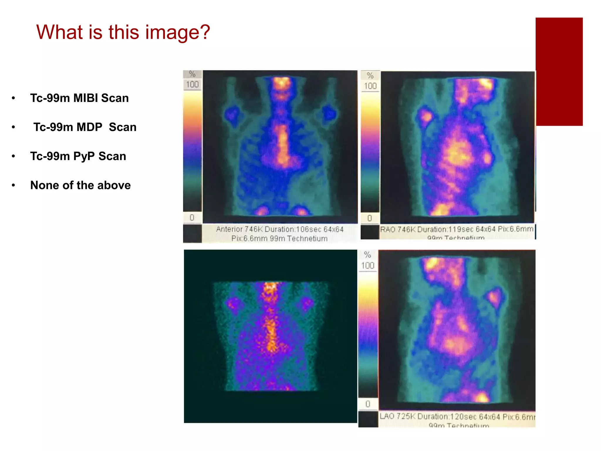 Diagnosis of Cardiac Amyloidosis with PYP Imaging | PPTX