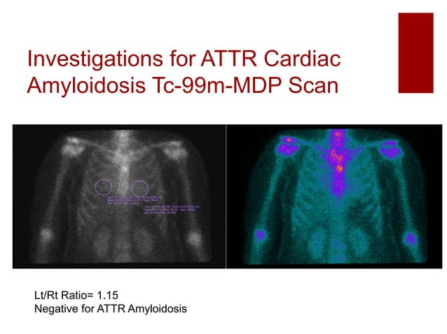 Diagnosis of Cardiac Amyloidosis with PYP Imaging