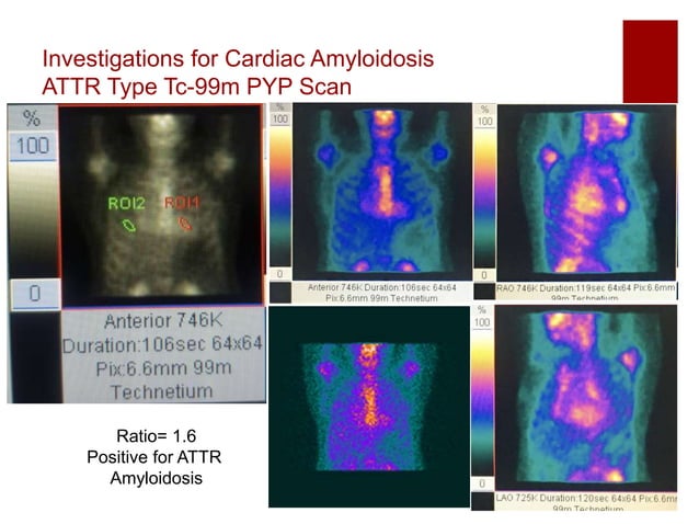 Diagnosis of Cardiac Amyloidosis with PYP Imaging