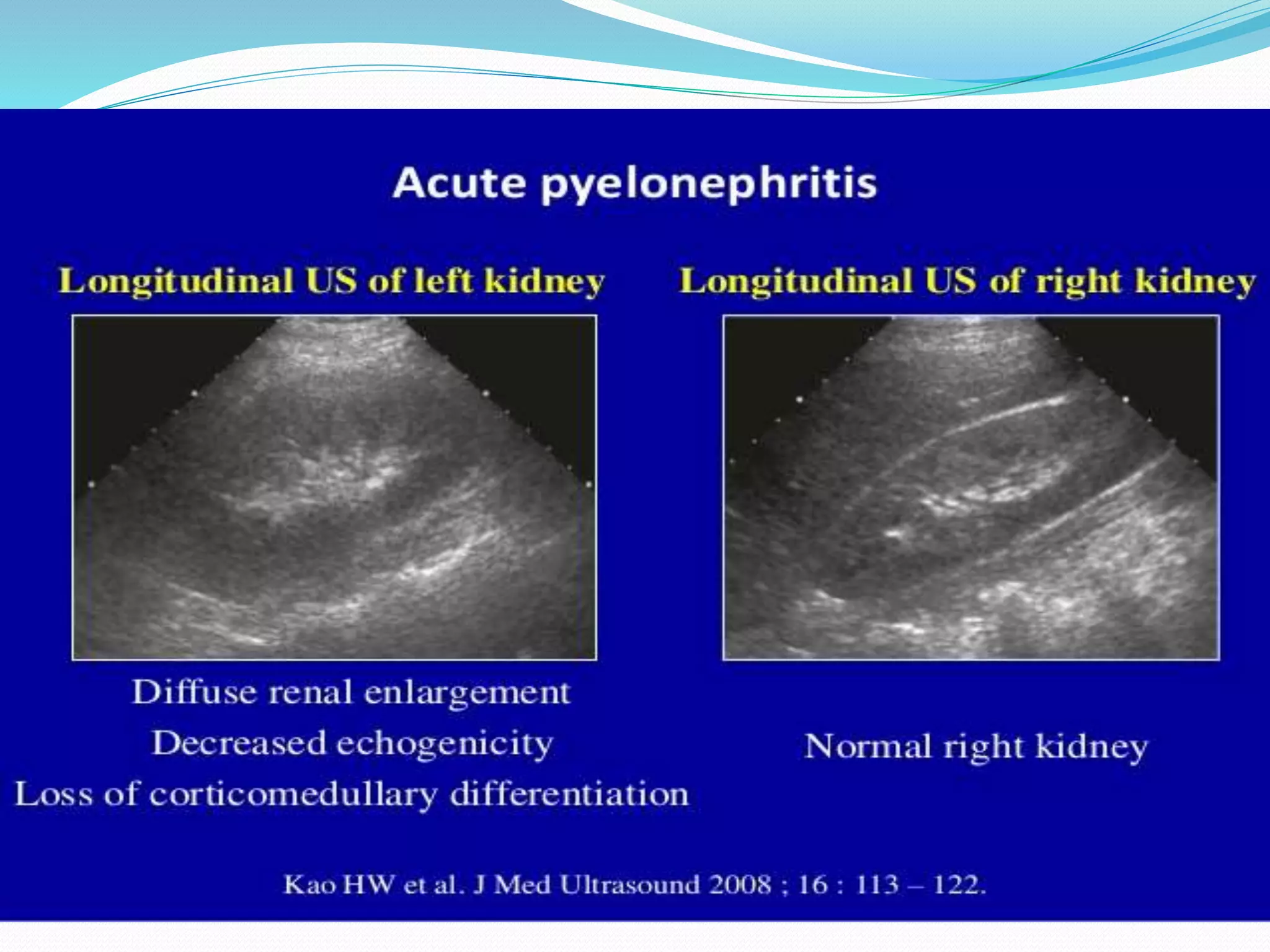 Pyuria and urinary tract infection 2 | PPTX