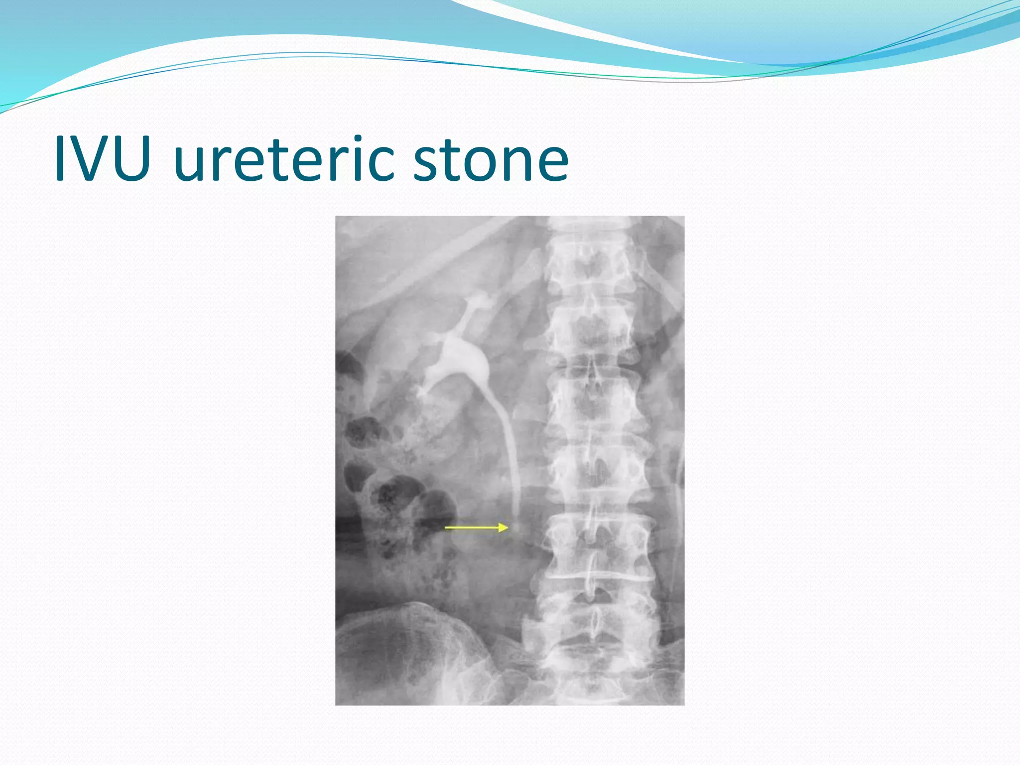 Pyuria and urinary tract infection 2 | PPTX