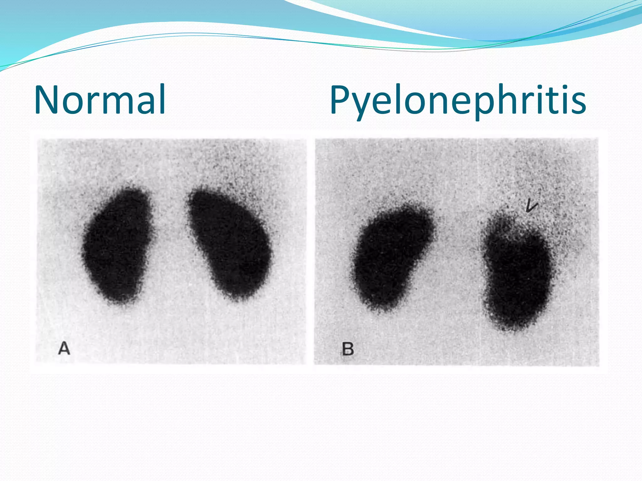 Pyuria and urinary tract infection 2 | PPTX