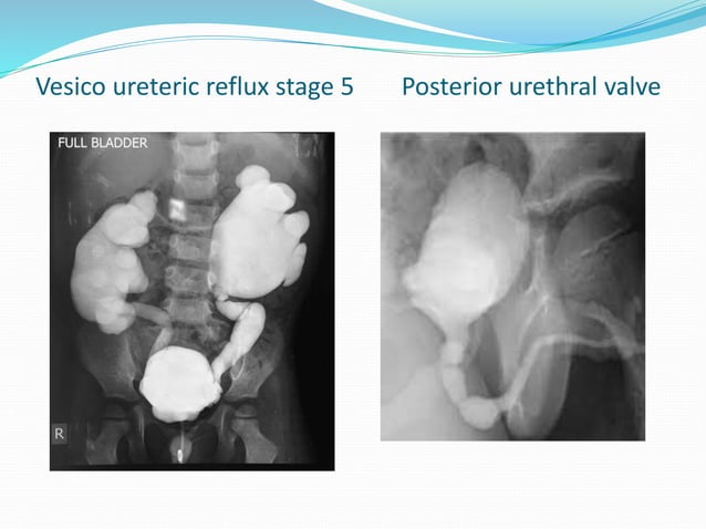 Pyuria and urinary tract infection 2 | PPTX