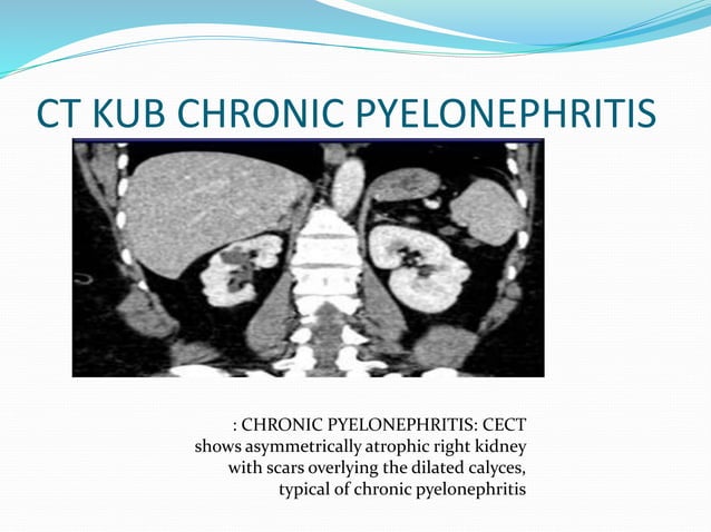 Pyuria and urinary tract infection 2 | PPTX