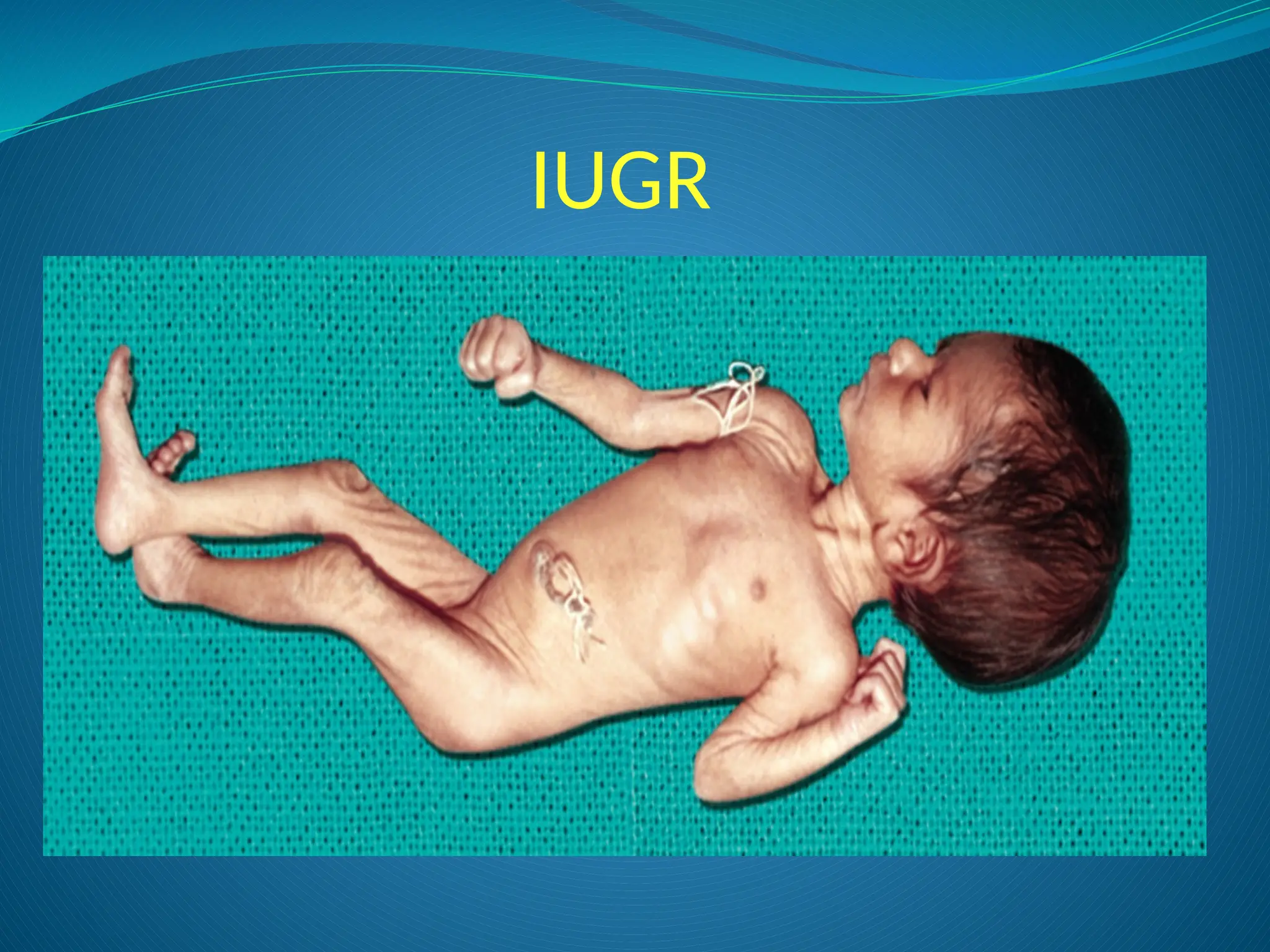 IUGR - intra uterine growth restriction. | PPTX