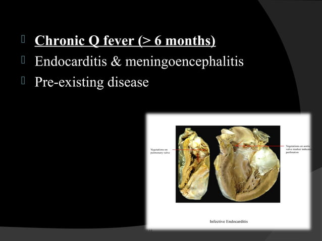 Q fever | PPT