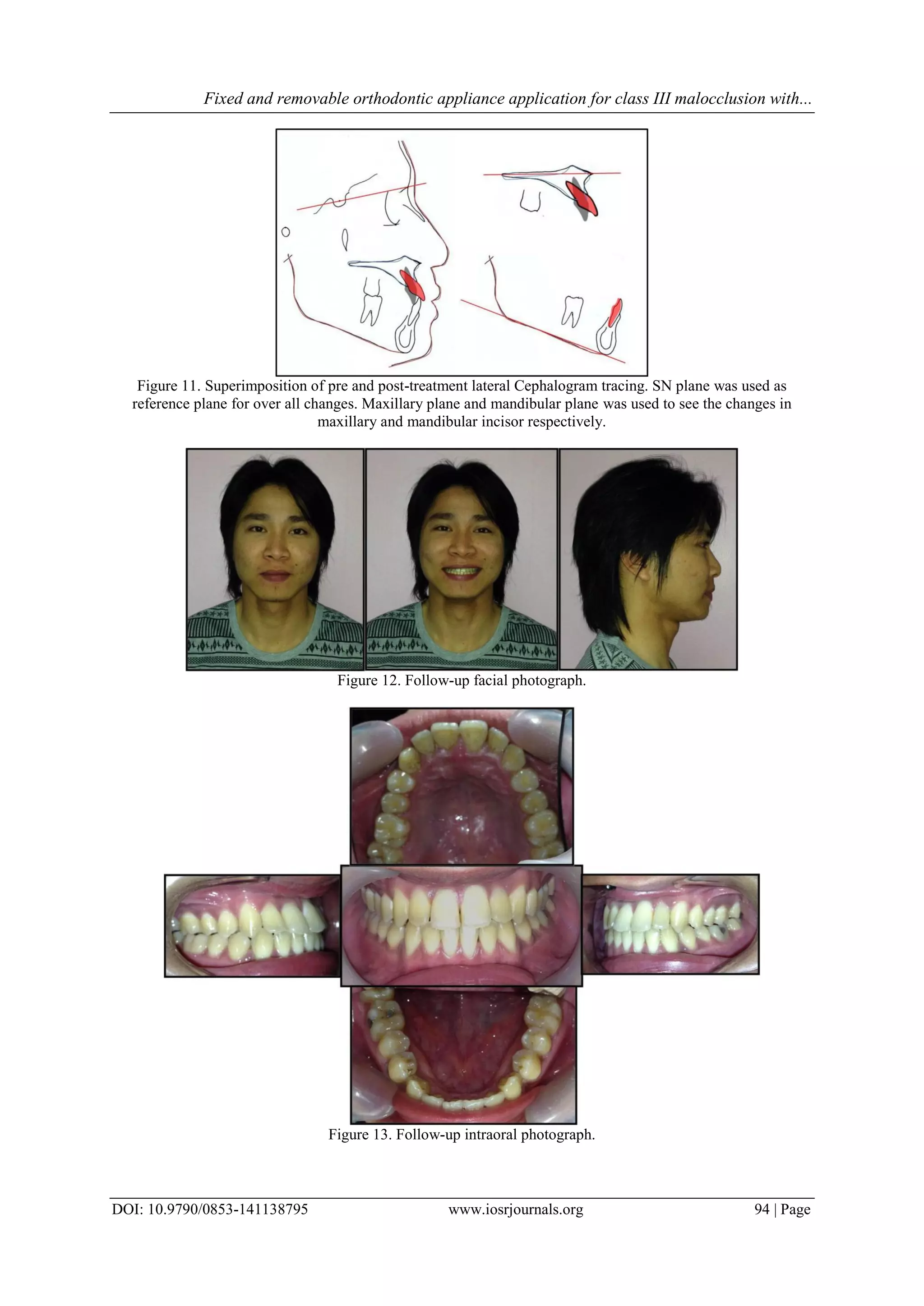 Fixed and removable orthodontic appliance application for class III ...
