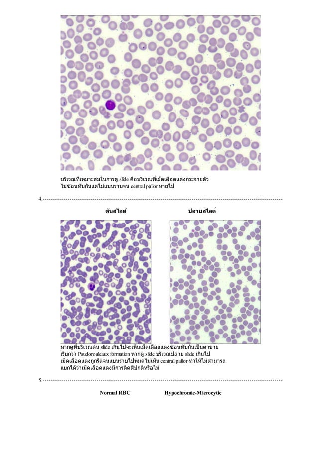 Peripheral blood smear