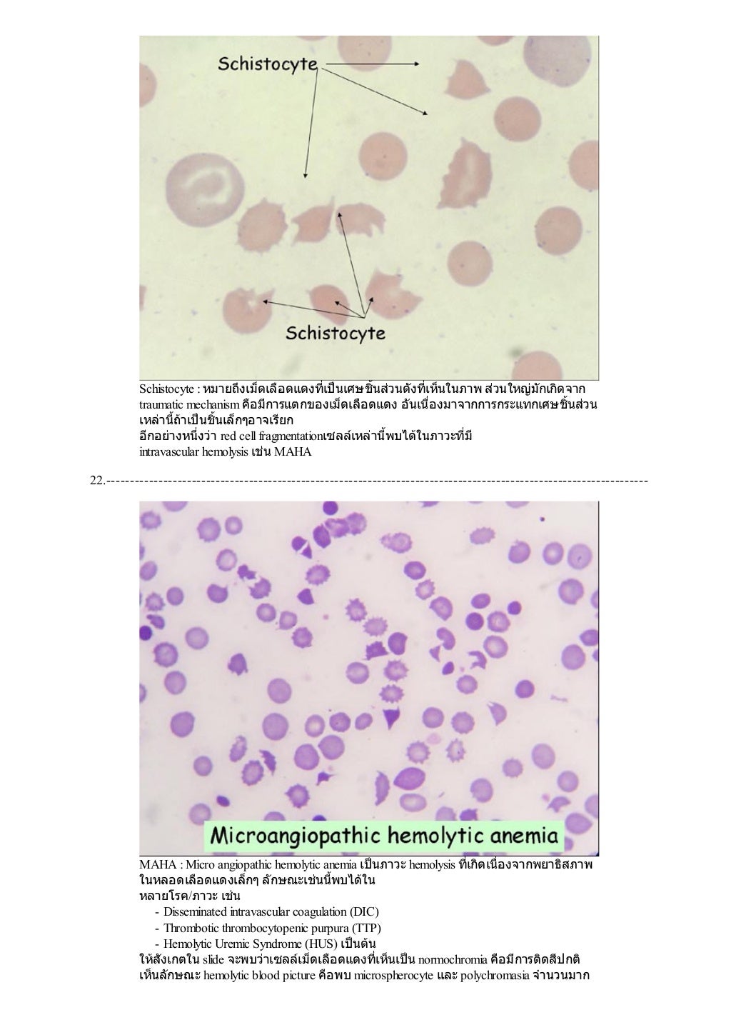 Peripheral blood smear