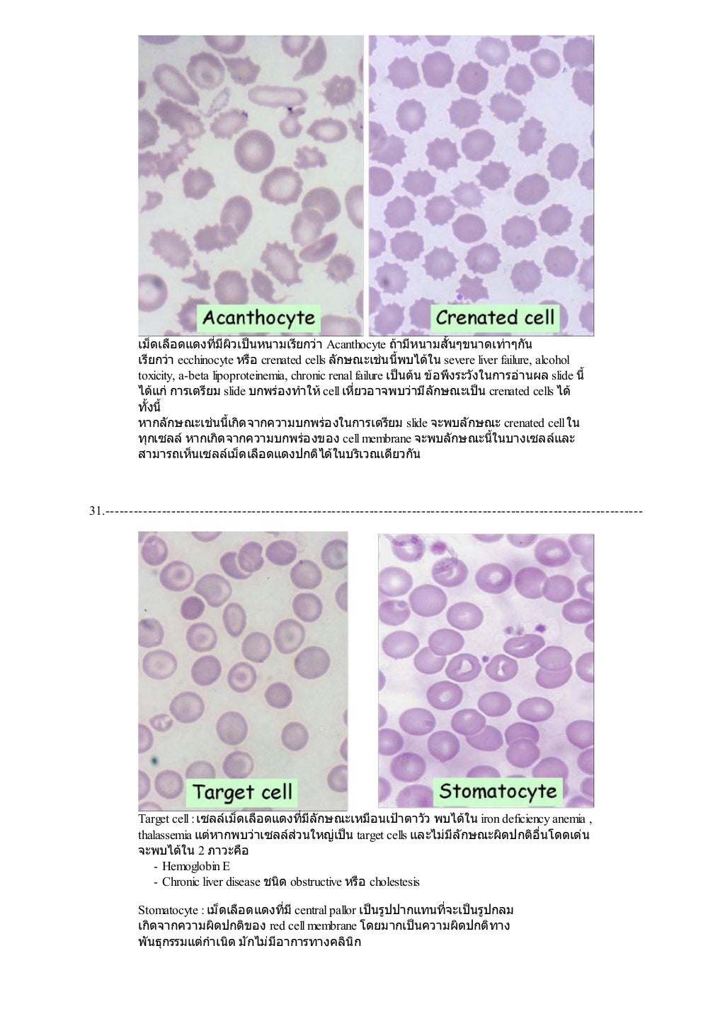 Peripheral blood smear