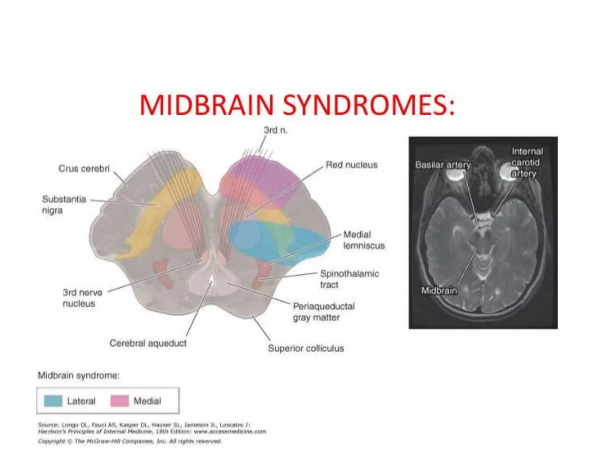 BRAINSTEM LESION INVOLVING 3rd,4th and 6th cranial nerve | PPTX