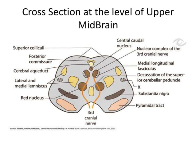 BRAINSTEM LESION INVOLVING 3rd,4th and 6th cranial nerve | PPTX | Eye ...