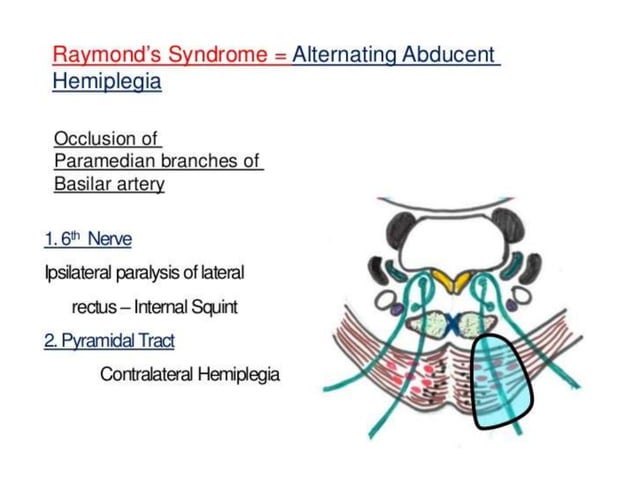 BRAINSTEM LESION INVOLVING 3rd,4th and 6th cranial nerve | PPTX | Eye ...