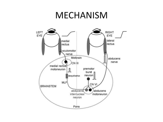 BRAINSTEM LESION INVOLVING 3rd,4th and 6th cranial nerve | PPTX | Eye ...