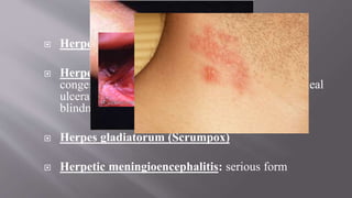 viral lesions of the oral cavity | PPT