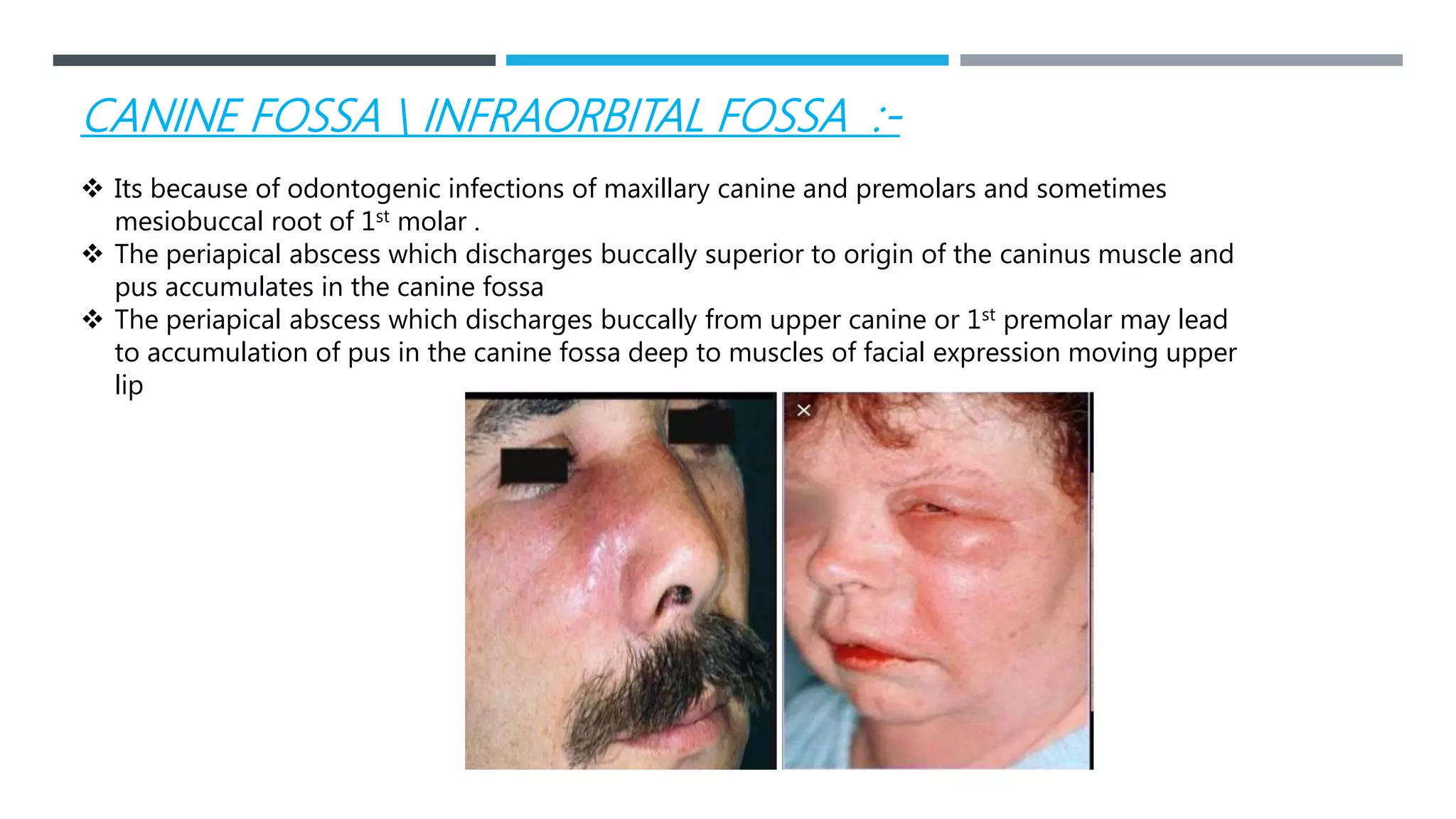 abscesses and phlegmonas of zygomatic , buccal | PPTX