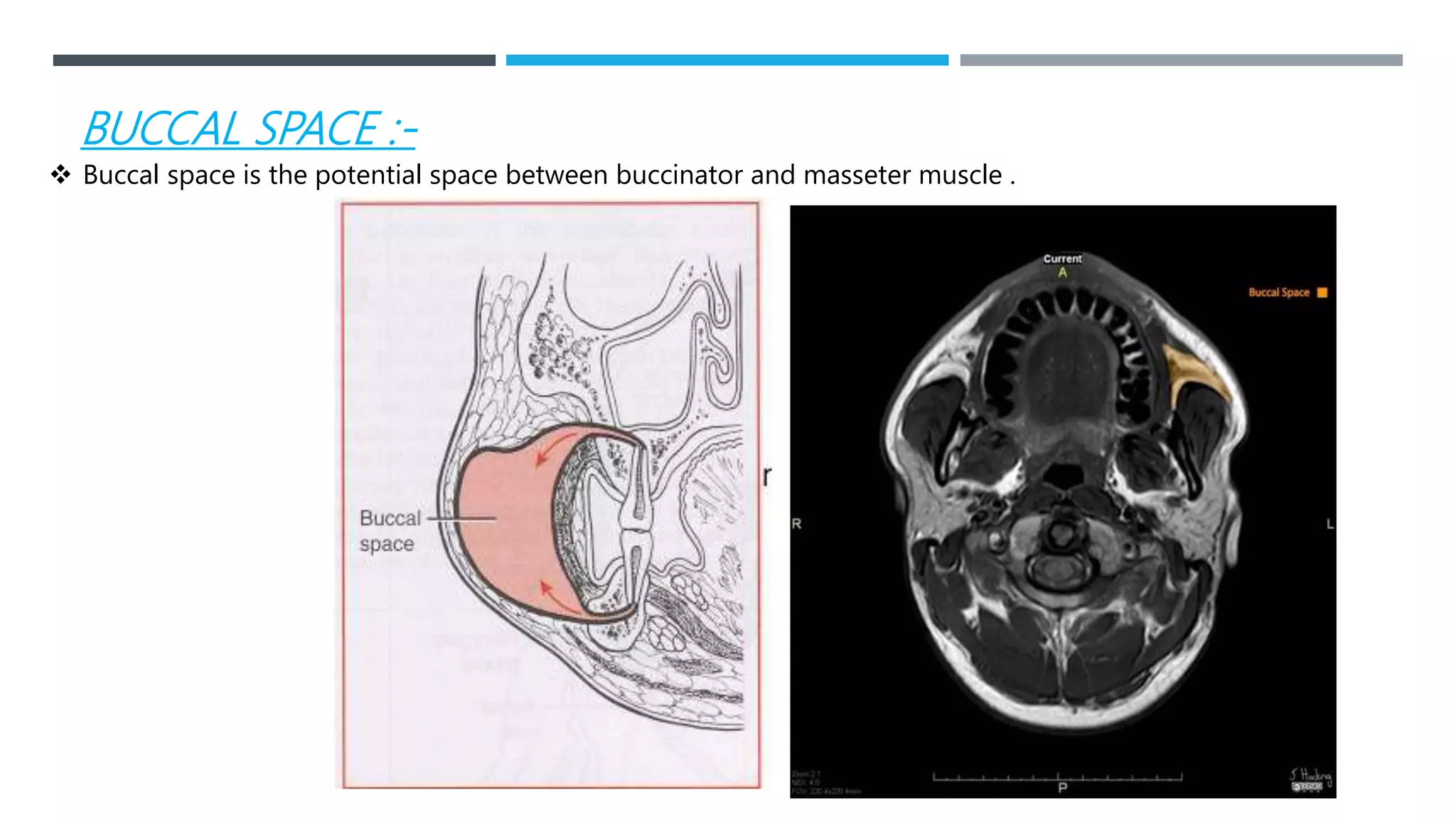 abscesses and phlegmonas of zygomatic , buccal | PPTX
