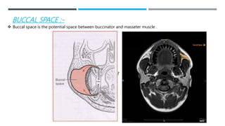 abscesses and phlegmonas of zygomatic , buccal | PPT
