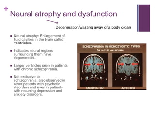 Q2 L04 - Schizophrenia | PPTX