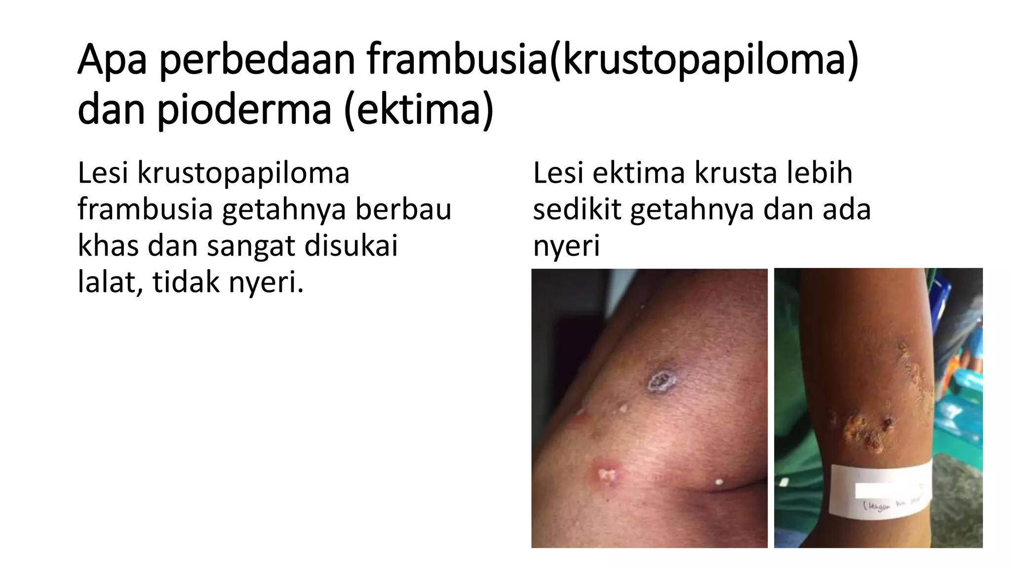 QA Frambusia.pptx