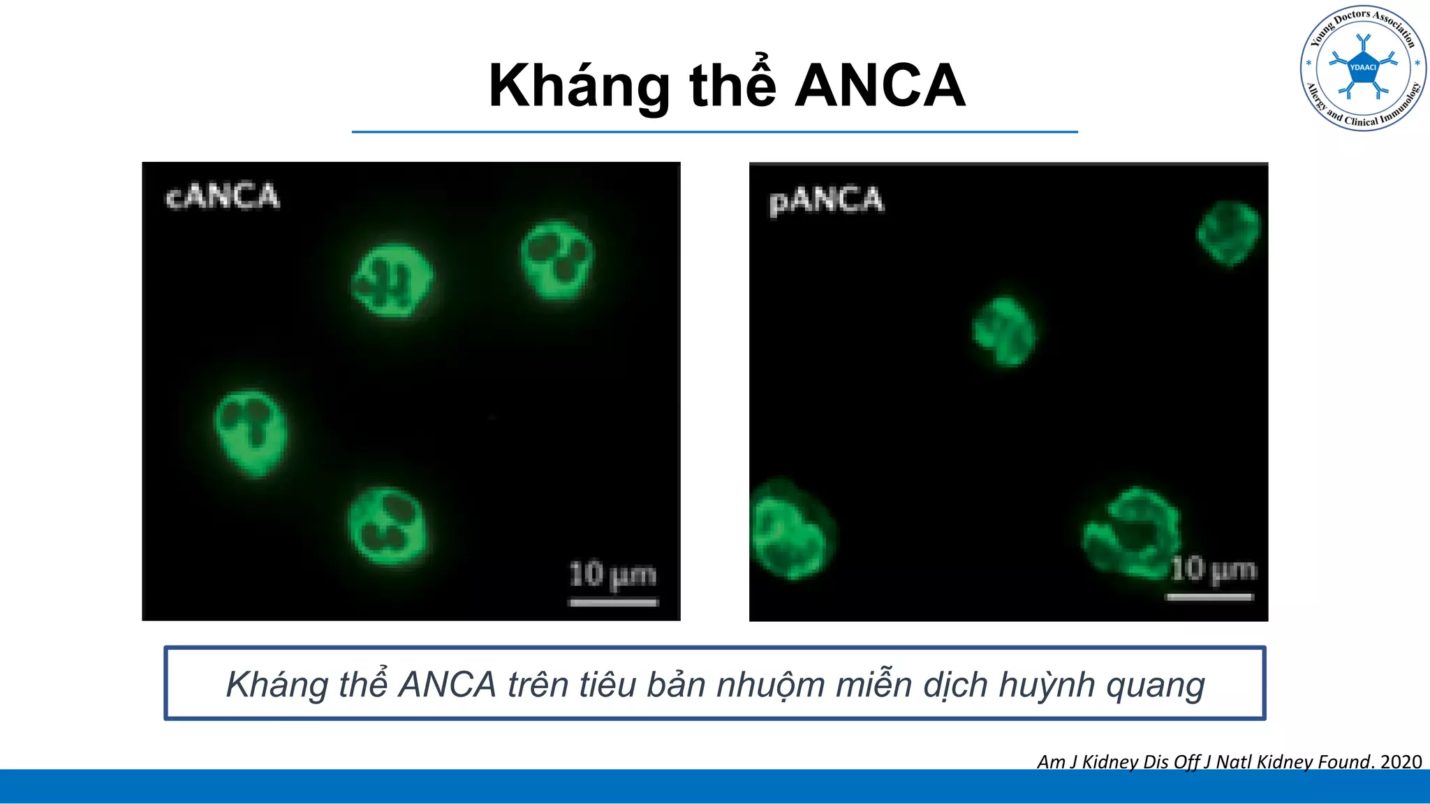 Viêm mạch ANCA | PDF