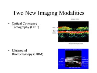 ultrasound biomicroscopy of the eye.ppt
