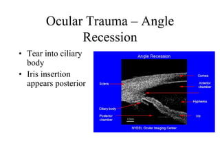 ultrasound biomicroscopy of the eye.ppt