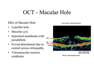 ultrasound biomicroscopy of the eye.ppt