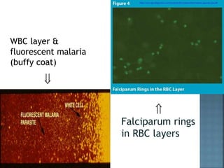Qbc test | PPTX | Infectious Diseases | Diseases and Conditions