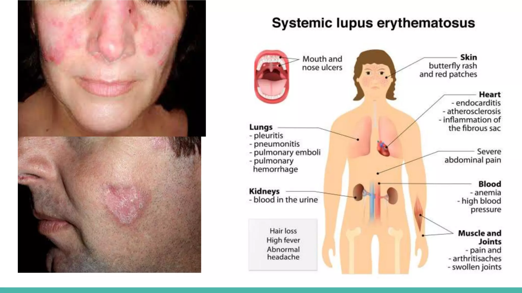 Systemic lupus erythematosus (SLE) | PPTX